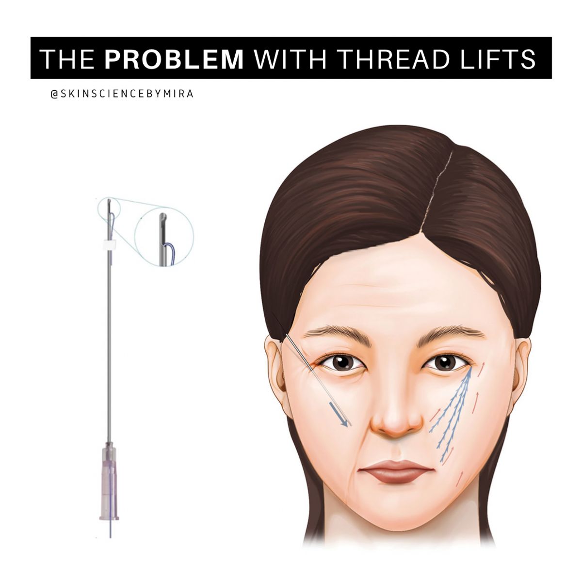 The Problem with Thread Lifts — skinsciencebymira - Buymeacoffee