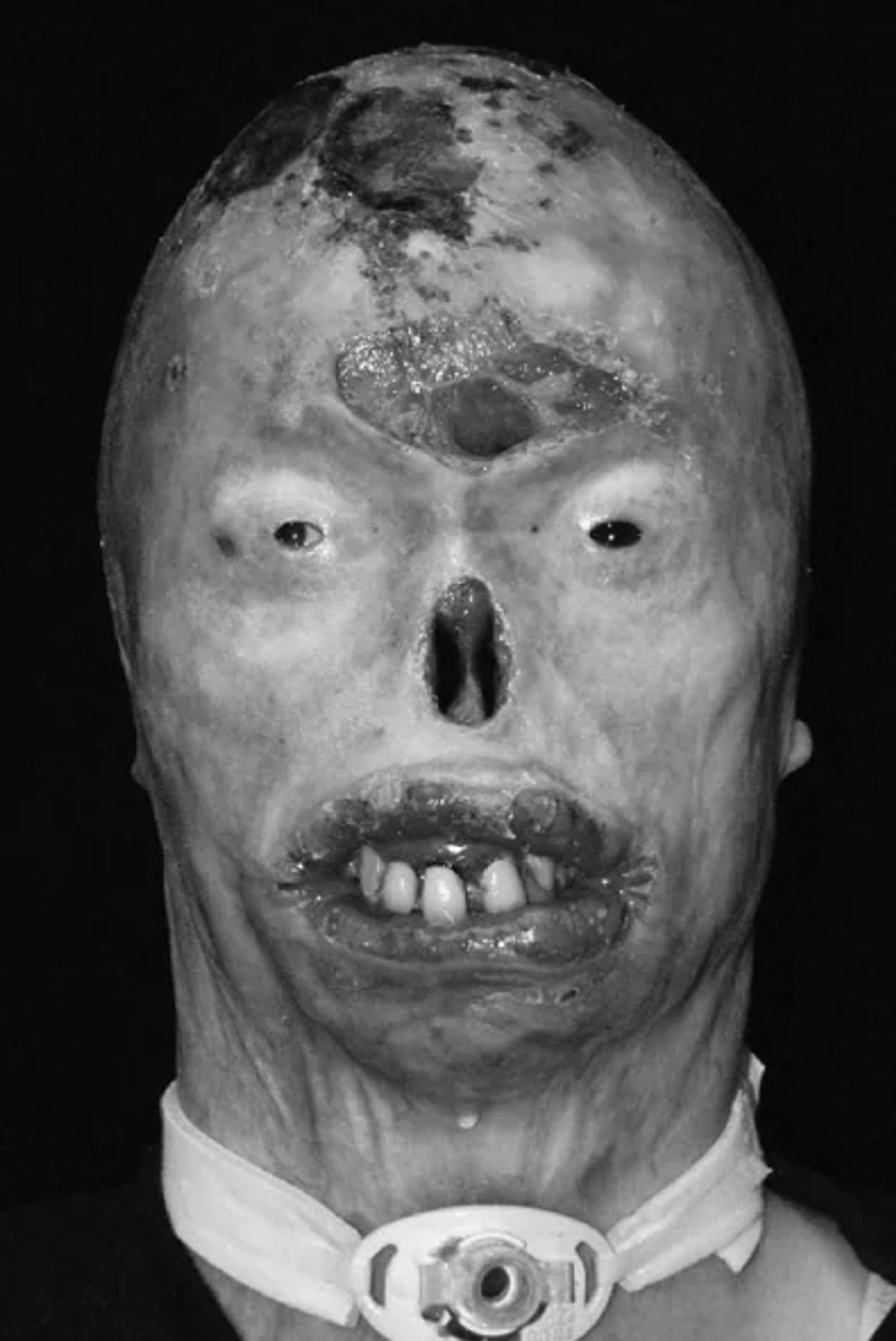 Total Face Reconstruction Using a Pre-expanded, Bilateral, Extended ...