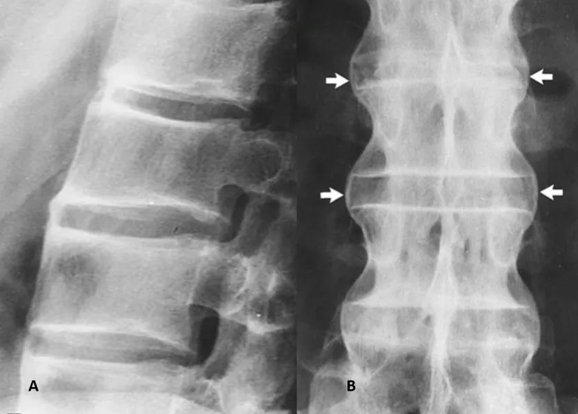 Spondylartrit, Ankyloserande spondylit (AS), Bechterews sjukdom ...