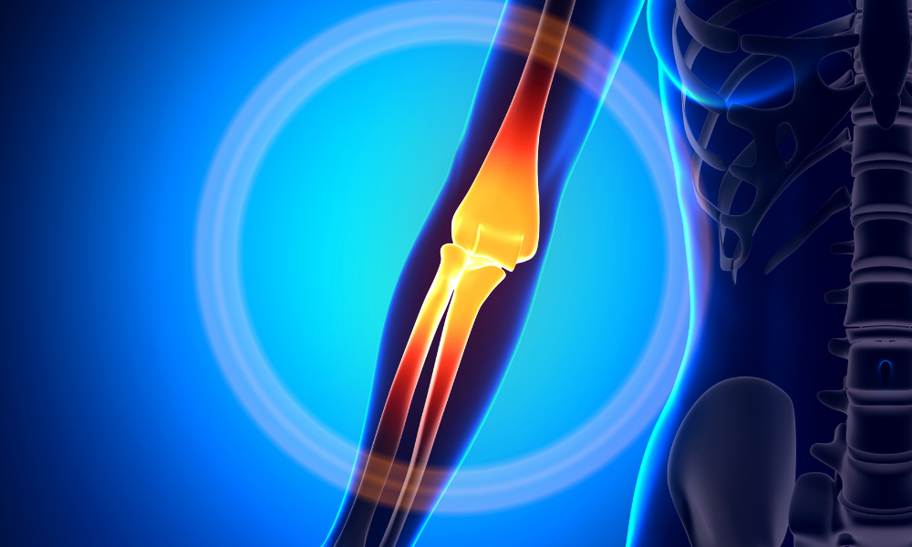 ¿Cuáles son los síntomas y causas más comunes del codo de tenista ...