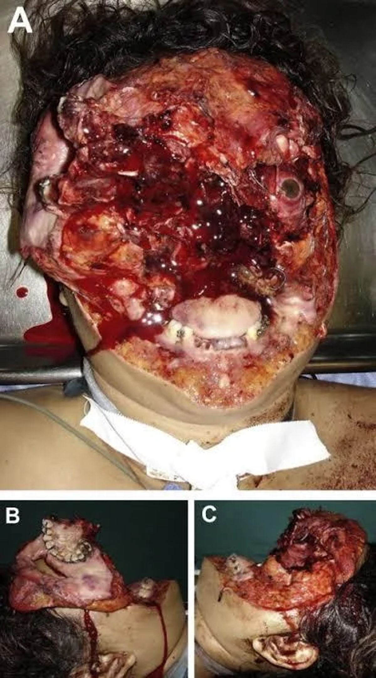 Severe Facial Trauma From A Rollover Automobile Accident Dr Weird Severe Facial Trauma From A Rollover Automobile Accident Dr Weird