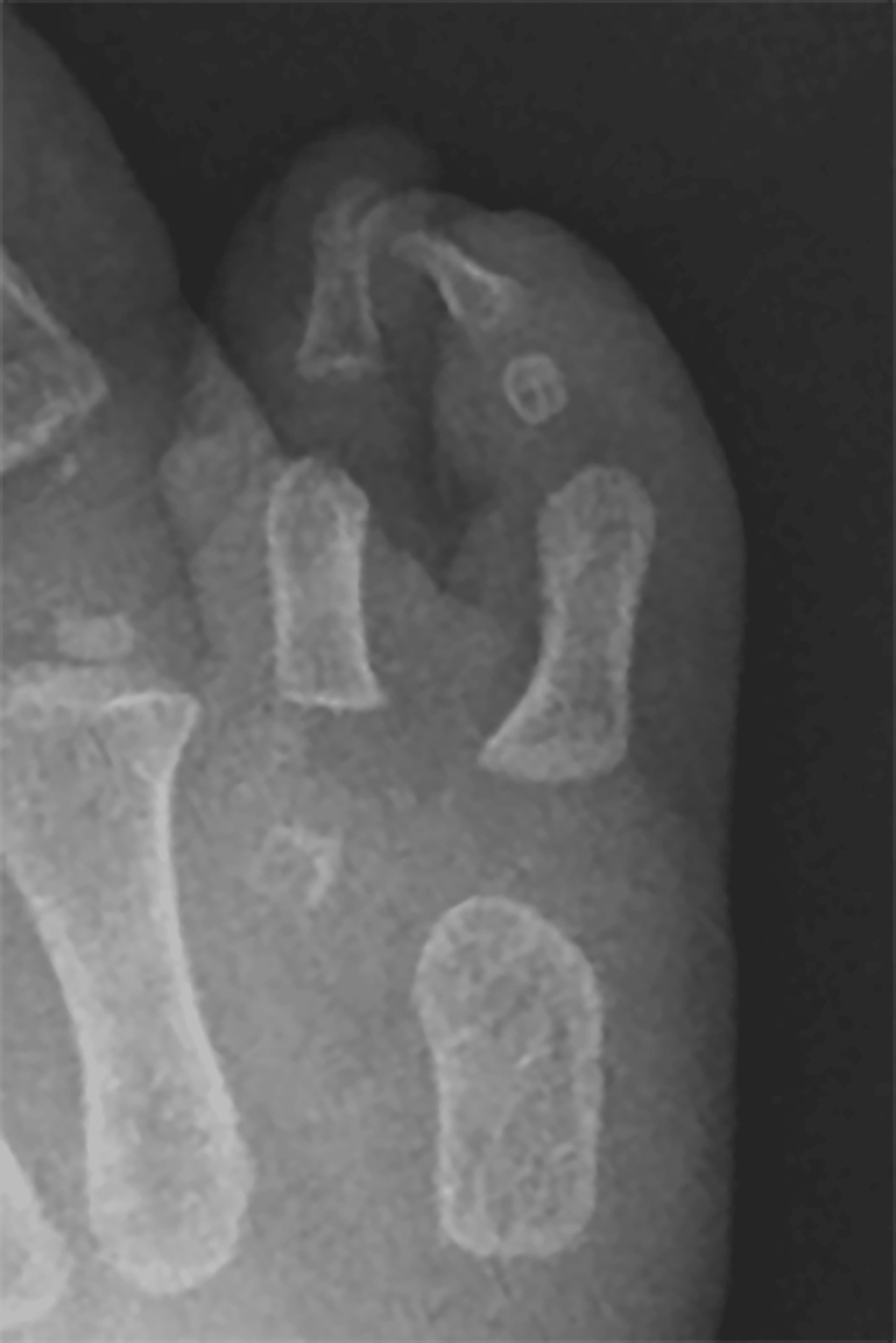 Atypical Radial Polydactyly Surgery — Dr.Weird - Buymeacoffee