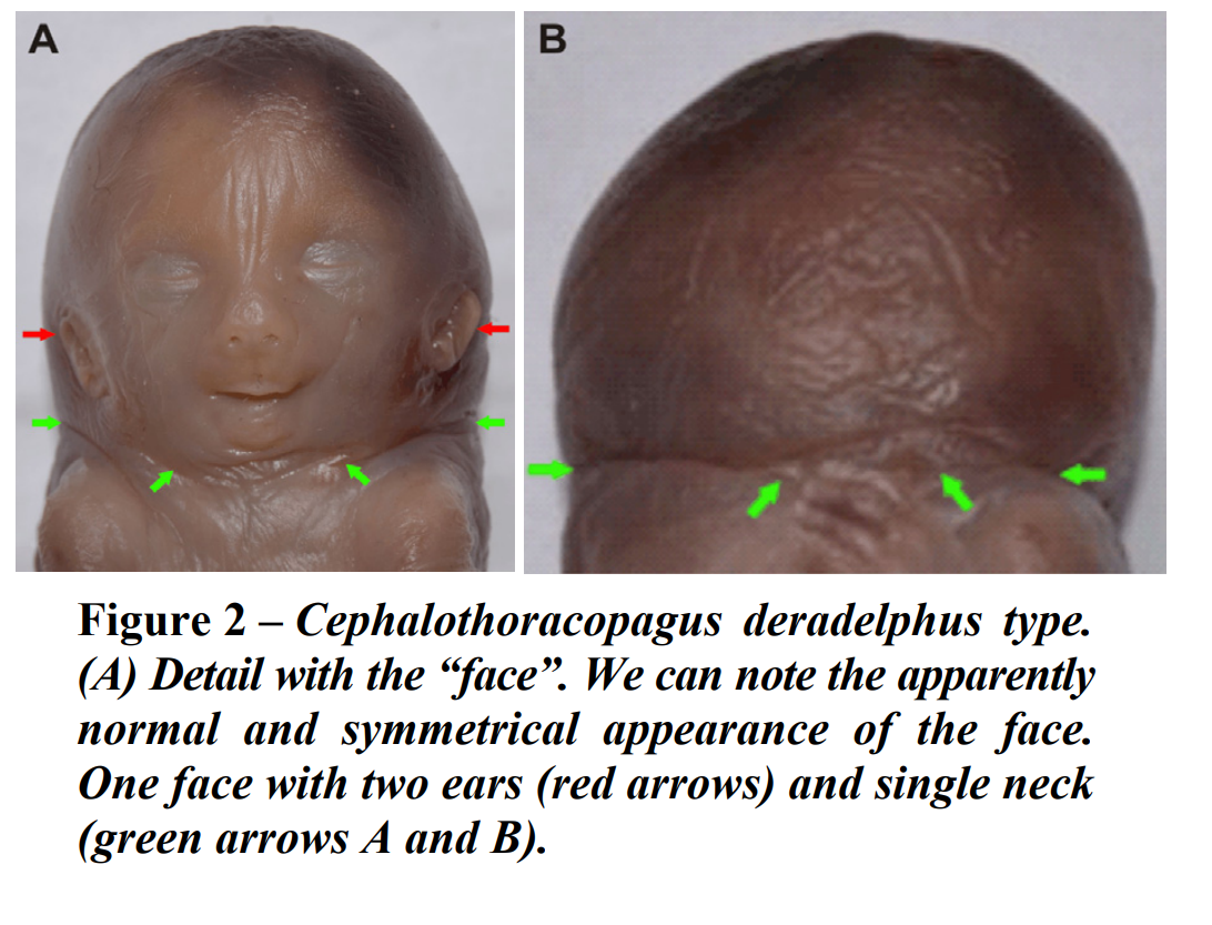 Morphological study of cephalothoracopagus deradelphus type conjoined ...