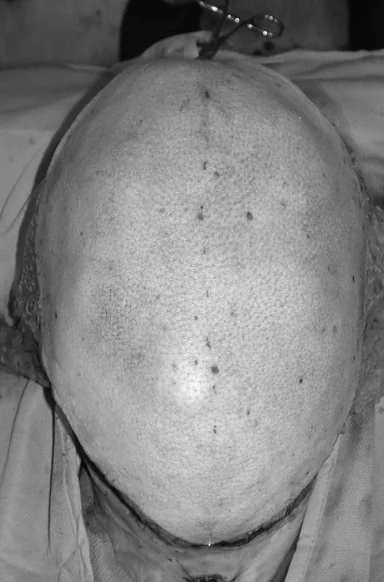 Total Face Reconstruction Using a Pre-expanded, Bilateral, Extended ...