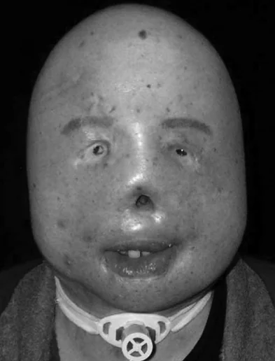 Total Face Reconstruction Using a Pre-expanded, Bilateral, Extended ...